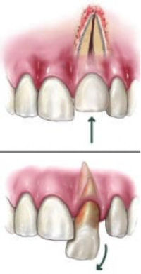 Trauma – Dr Fergus Duddy Endodontics